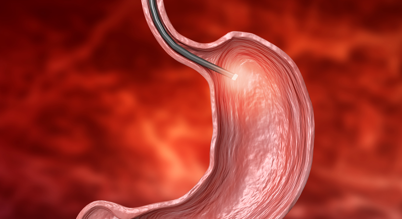 Gastroscopy - Clinique Méditerranéenne