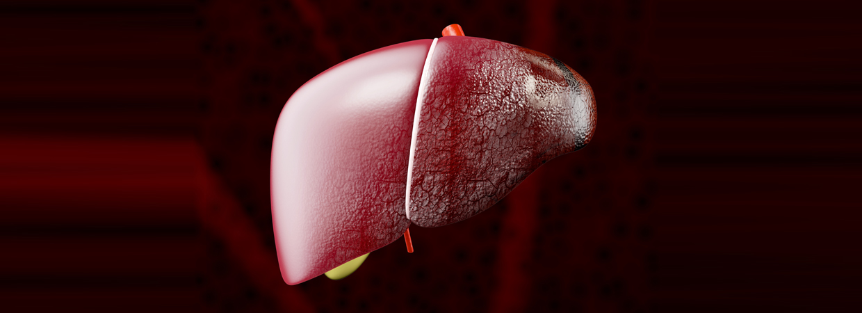 liver cirrhosis - Clinique Méditerranéenne